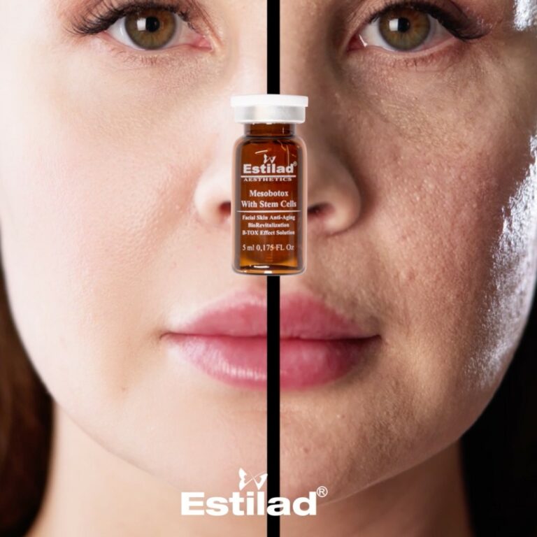 Estilad Mesobotox Before/After - Estilad Official - Leading ...